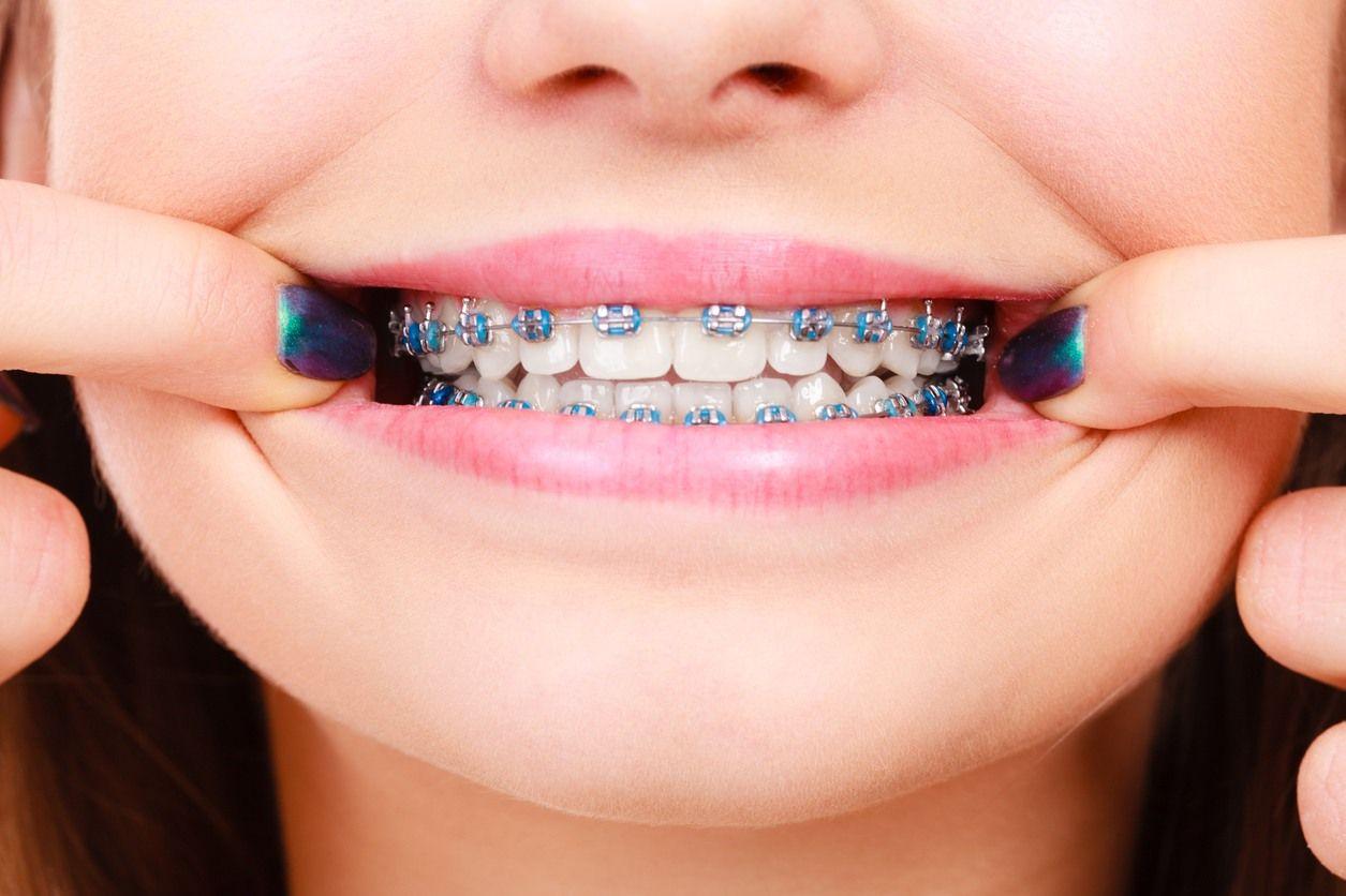 Orthodontic Wallpapers - Top Free Orthodontic Backgrounds - WallpaperAccess