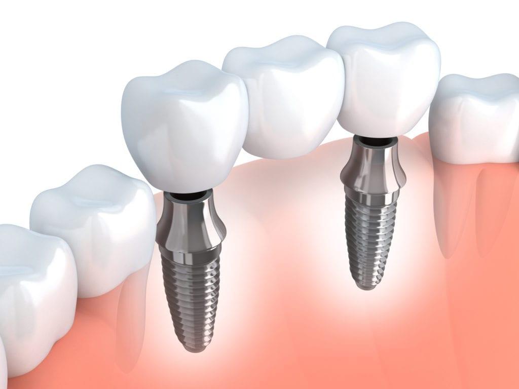 Dental Implant Wallpapers - Top Free Dental Implant Backgrounds ...