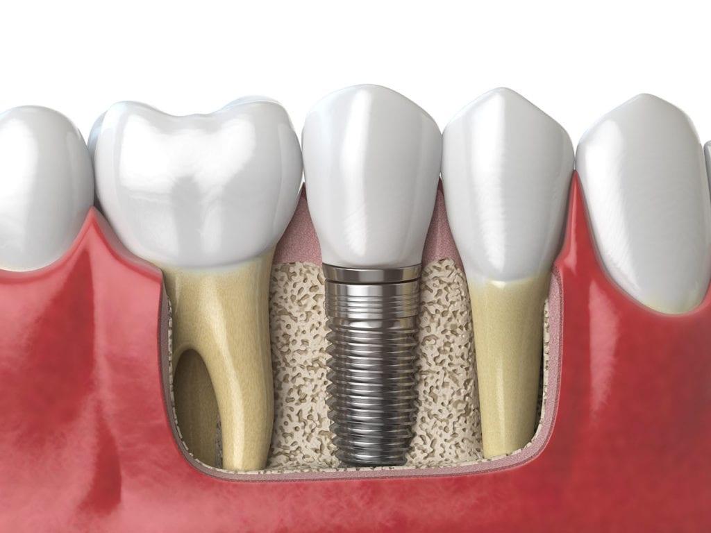 Dental Implant Wallpapers - Top Free Dental Implant Backgrounds ...