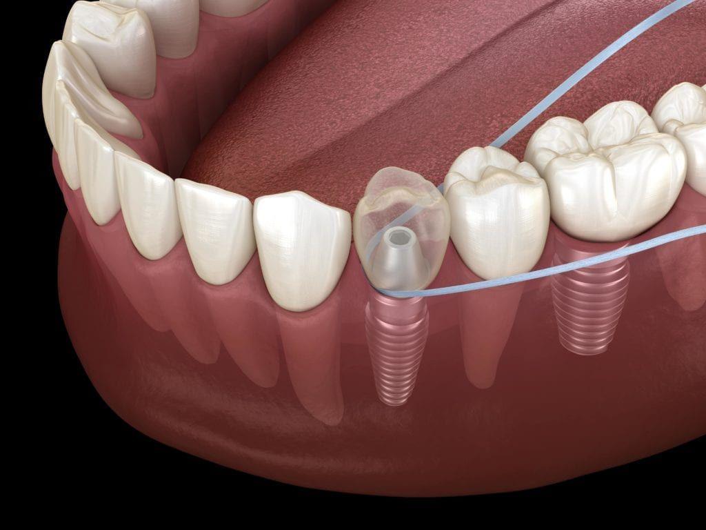 Dental Implant Wallpapers - Top Free Dental Implant Backgrounds ...