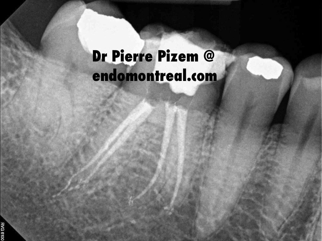 Root Canal Treatment Wallpapers - Top Free Root Canal Treatment ...