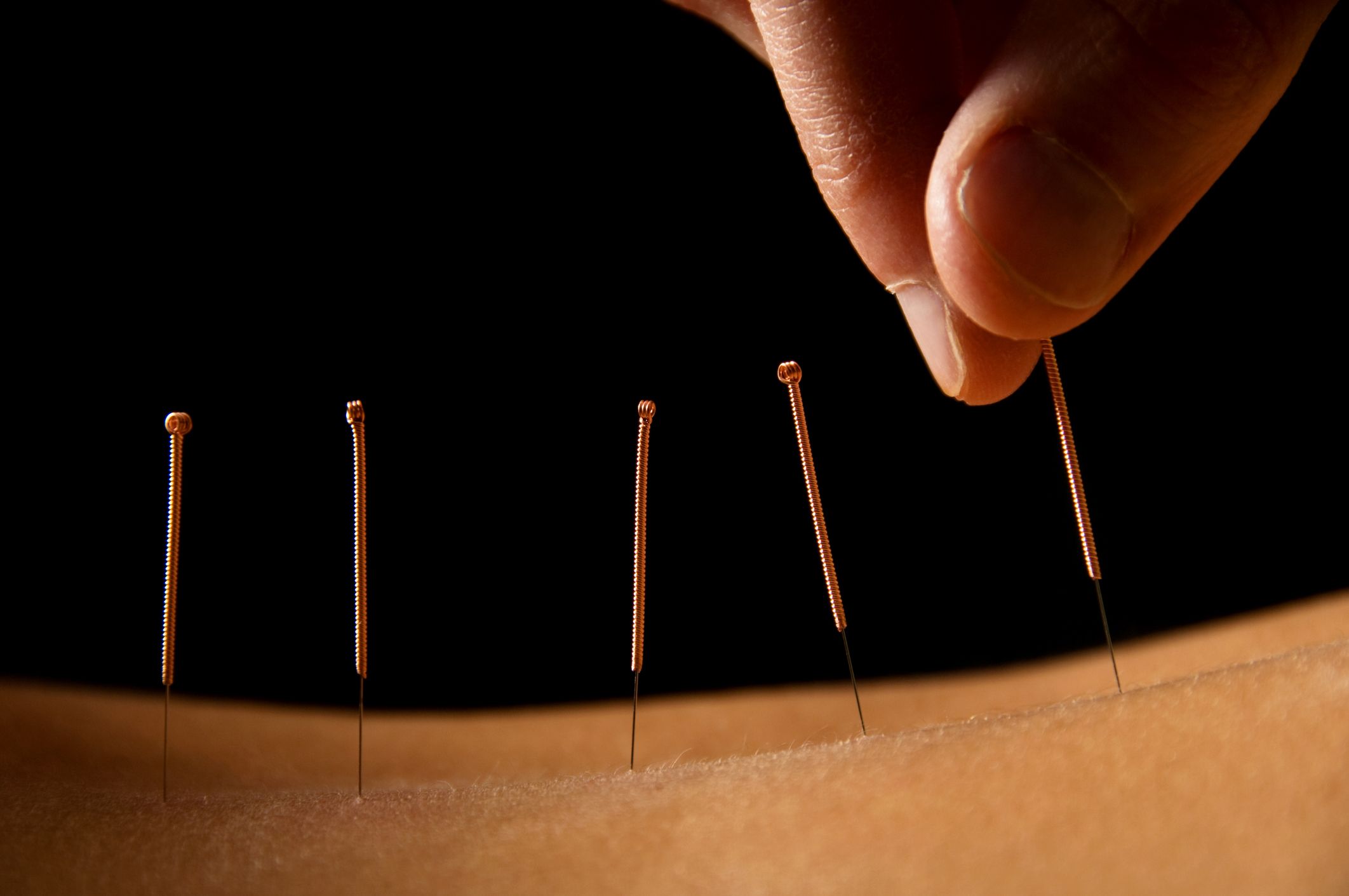 Acupuncture Wallpapers - Top Free Acupuncture Backgrounds - WallpaperAccess