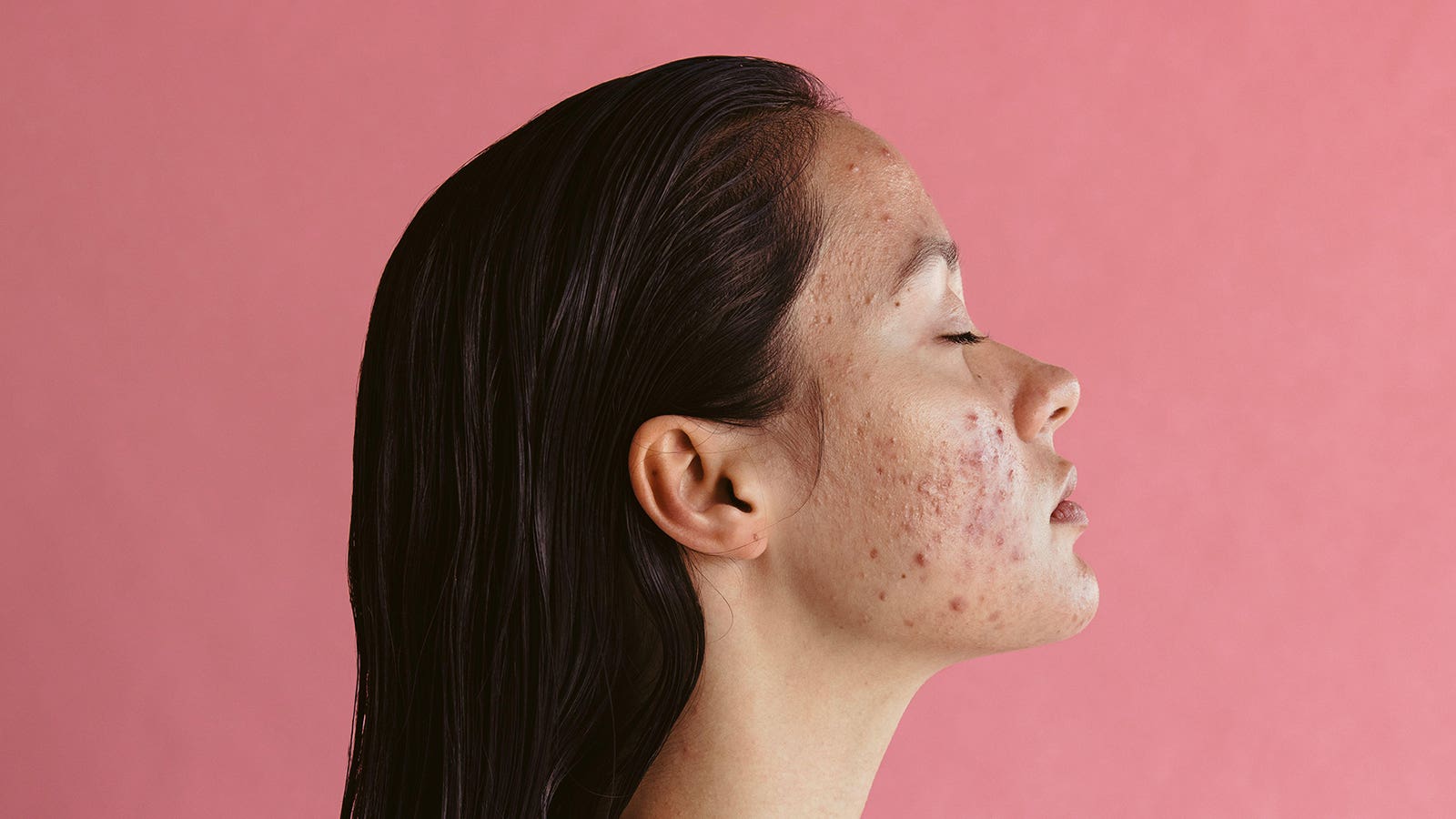 Pimple Wallpapers - Top Free Pimple Backgrounds - WallpaperAccess