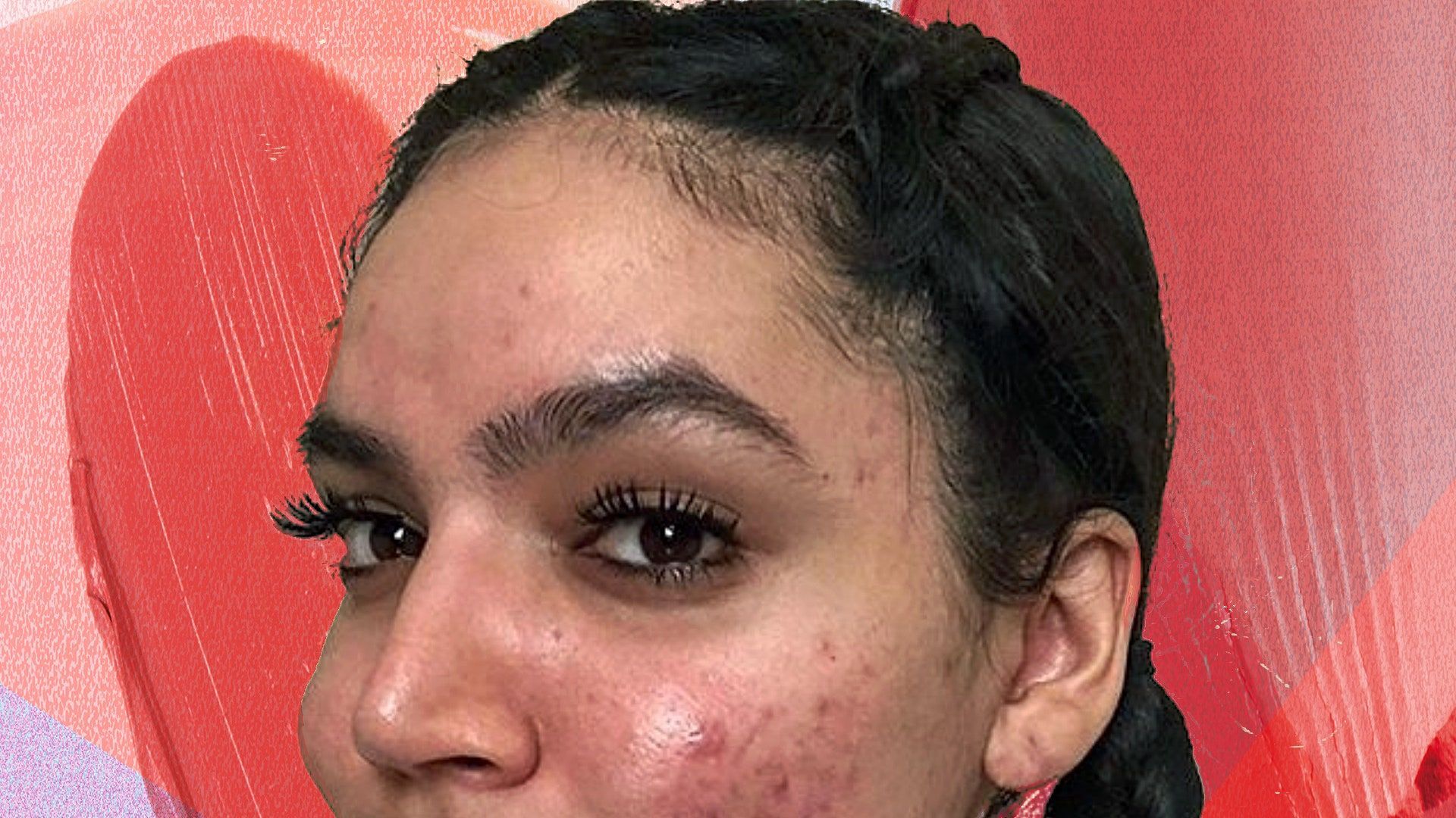 Pimple Wallpapers - Top Free Pimple Backgrounds - WallpaperAccess