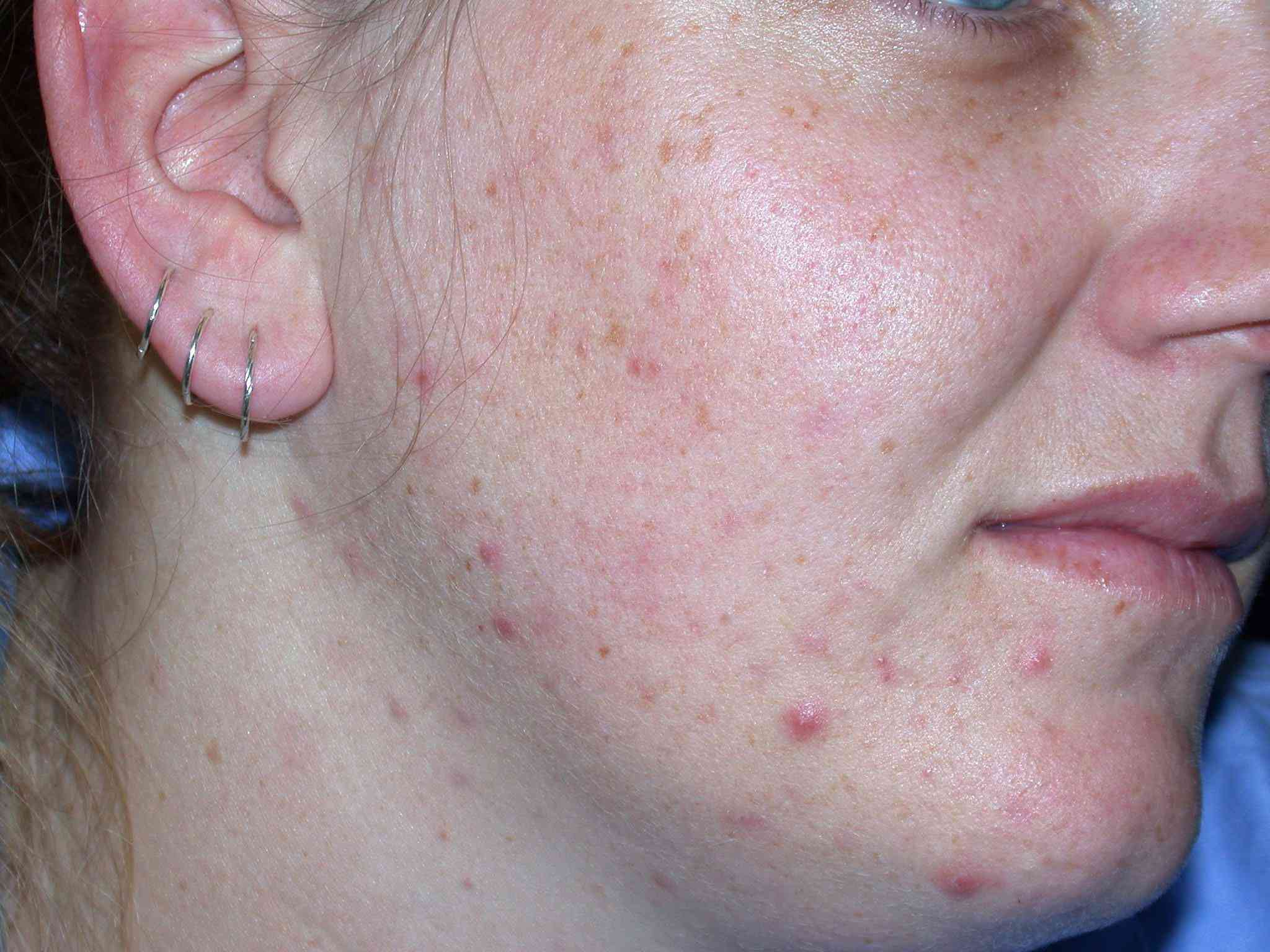 Pimple Wallpapers - Top Free Pimple Backgrounds - WallpaperAccess